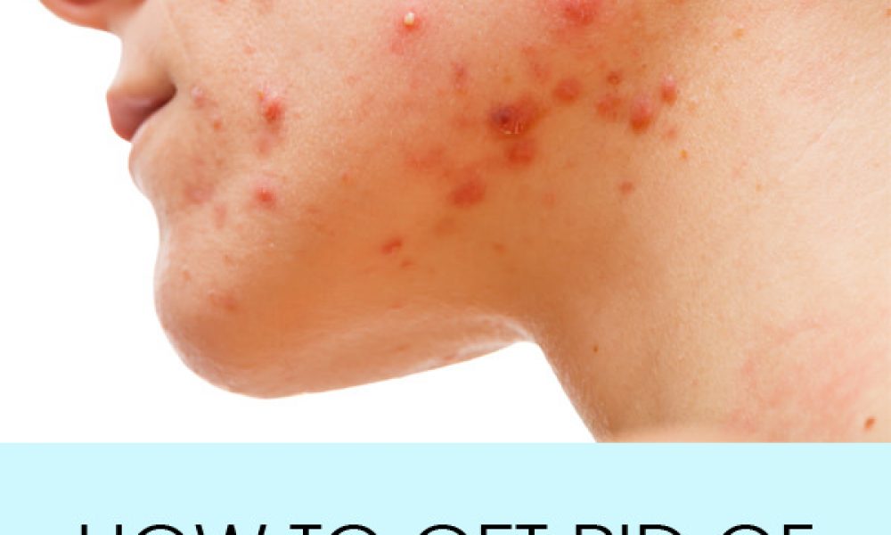 How To Get Rid Of Acne Fast 3 Effective Ways Fashion Daily